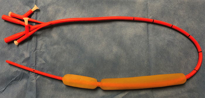 Minnesota Tube Utility in Non-Variceal Distal Esophageal Hemorrhage ...