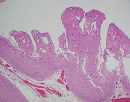 Early Prophylactic Gastrectomy for the Management of Gastric ...