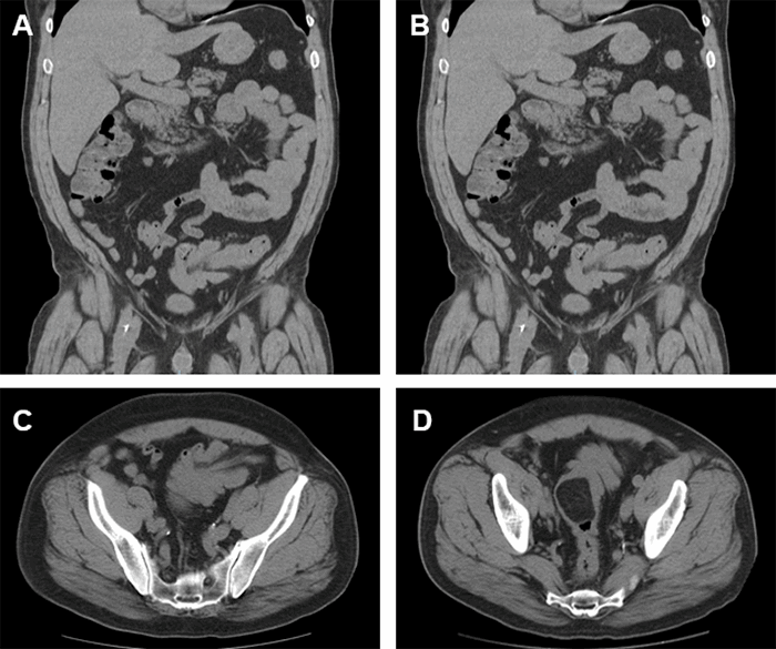 Submucosal Sigmoid Lipoma Acting as Unusual Lead Point of Colocolic ...