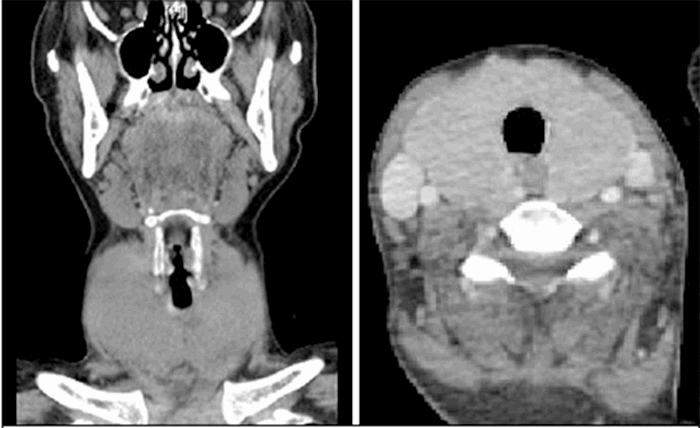 Iodinated Contrast-Induced Thyrotoxicosis in the Trauma Patient | ACS