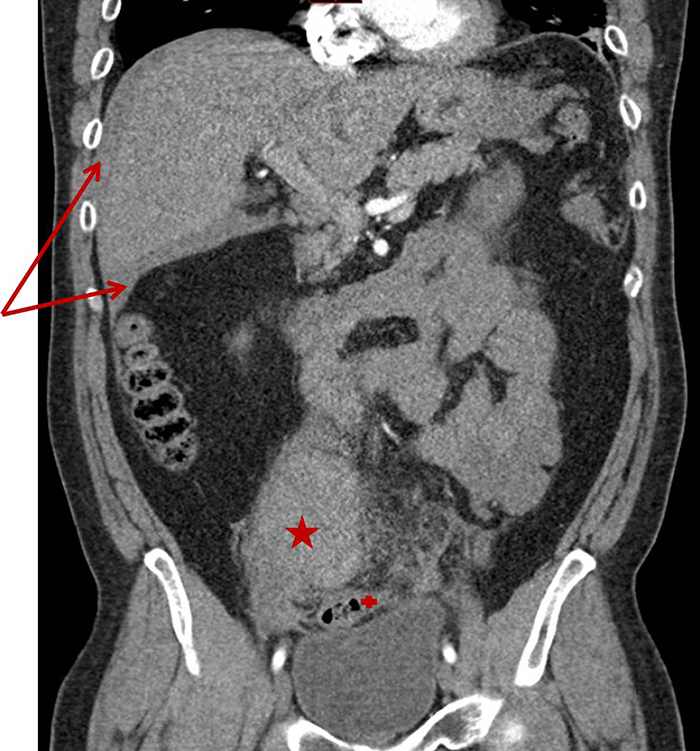 Spontaneous Hemoperitoneum in Sigmoid Diverticular Disease | ACS