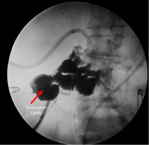 Giant Perforated Duodenal Diverticulum Management | ACS