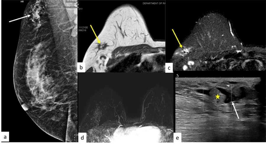 Breast Pain, Palpable Mass, and a Perplexing Diagnosis | ACS