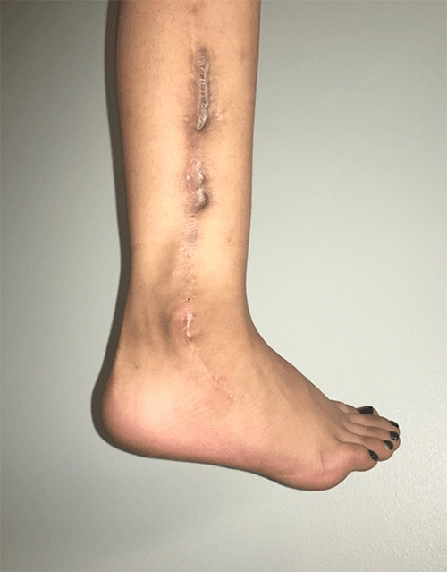 Free Microvascular Transfer of the Proximal Fibular Epiphysis to ...