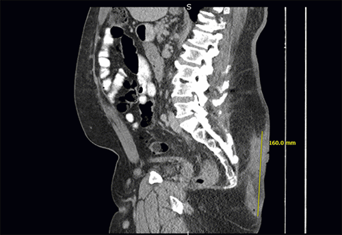 Perianal Squamous Cell Carcinoma: A Rare Presentation of Longstanding ...