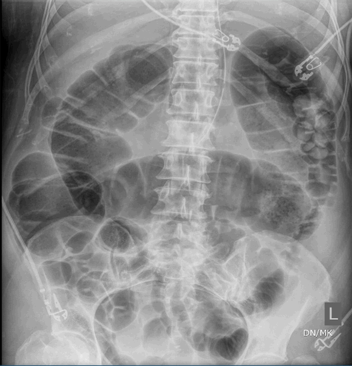 Colonic Paralytic Ileus in COVID-19 Patients | ACS