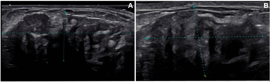 Bilateral Extra-Abdominal Desmoid Tumors of the Breast Treated with ...