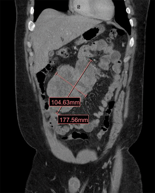 Primary Malignant Melanoma of the Small Intestine in a Young Adult | ACS