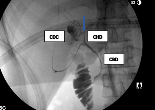 Surgical Management of an Intrahepatic Type II Choledochal Cyst | ACS