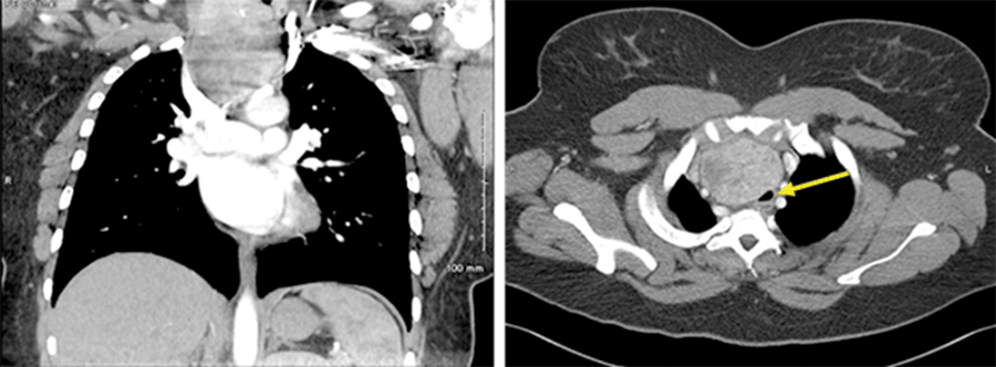 Antepartum Thyroidectomy for Retrosternal Thyroid Goiter | ACS