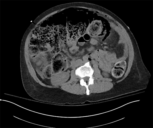 Stercoral Ulcer Perforation in a Young Woman at 29 Weeks Gestation ...