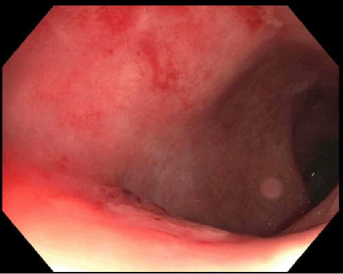Lamotrigine in the Treatment of Refractory Solitary Rectal Ulcer in an ...