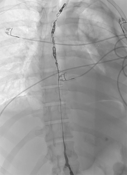 Repeat Thoracic Duct Embolization in Traumatic Thoracic Duct Injury: An ...