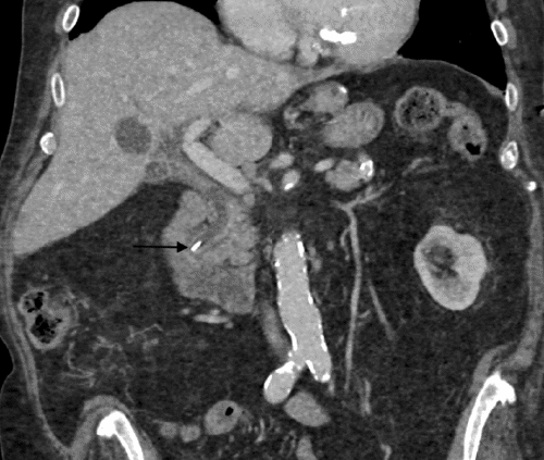 Metallic Clip Migration and Primary Common Duct Stone Formation After ...
