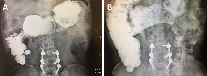 Ligament Of Treitz X Ray