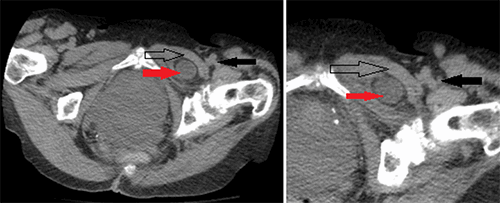 Rare Concurrent Obturator and Sciatic Hernia: Pathophysiology, Diagnosis, and Management | ACS