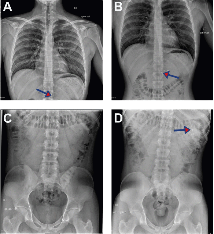 Stick a Pin in It: Amyand Revisited | ACS
