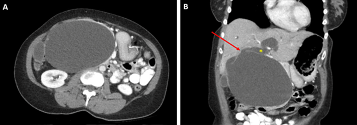 Giant Choledochal Cyst Presenting With Biliary Obstruction Without ...