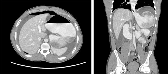 Perforated Gastric Volvulus in a Patient with Prior Surgery for ...