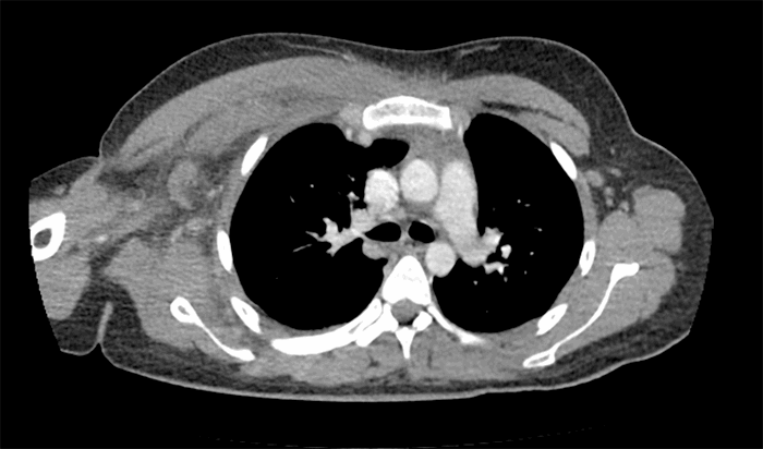 A Rare Case of Necrotizing Streptococcal Myositis of the Chest and ...