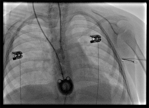 Misplacement of an Internal Jugular Chemo-Port into the Epidural Space ...