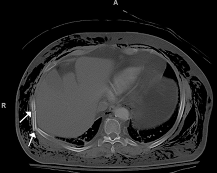 Traumatic Lung Herniation, Repair With Rib Fixation | ACS