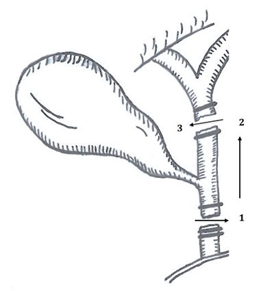 Laparoscopic Gallstone Removal From Common Bile Duct