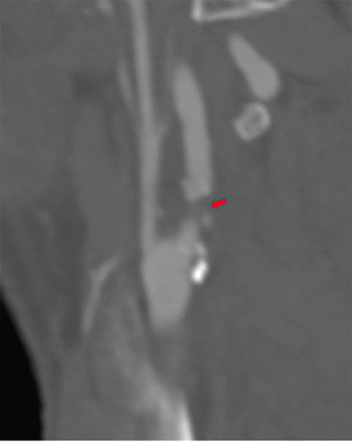 Binocular Amaurosis Fugax Treated with Staged Bilateral Transcarotid ...