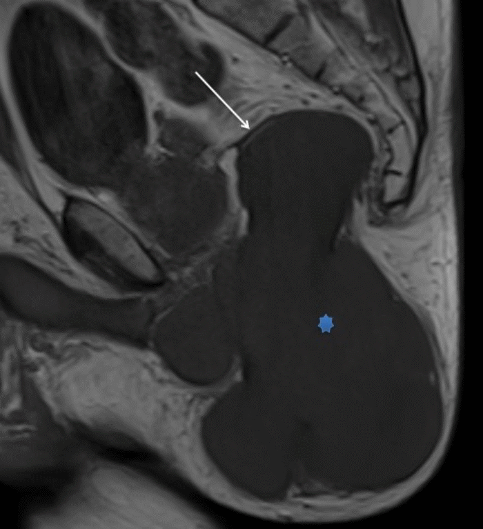Surgical Approach for a Gluteal Neurofibroma | ACS
