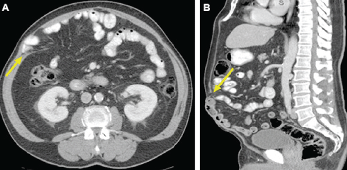 Lateral and Anterior Fascial Release with Onlay Mesh: An Elegant ...