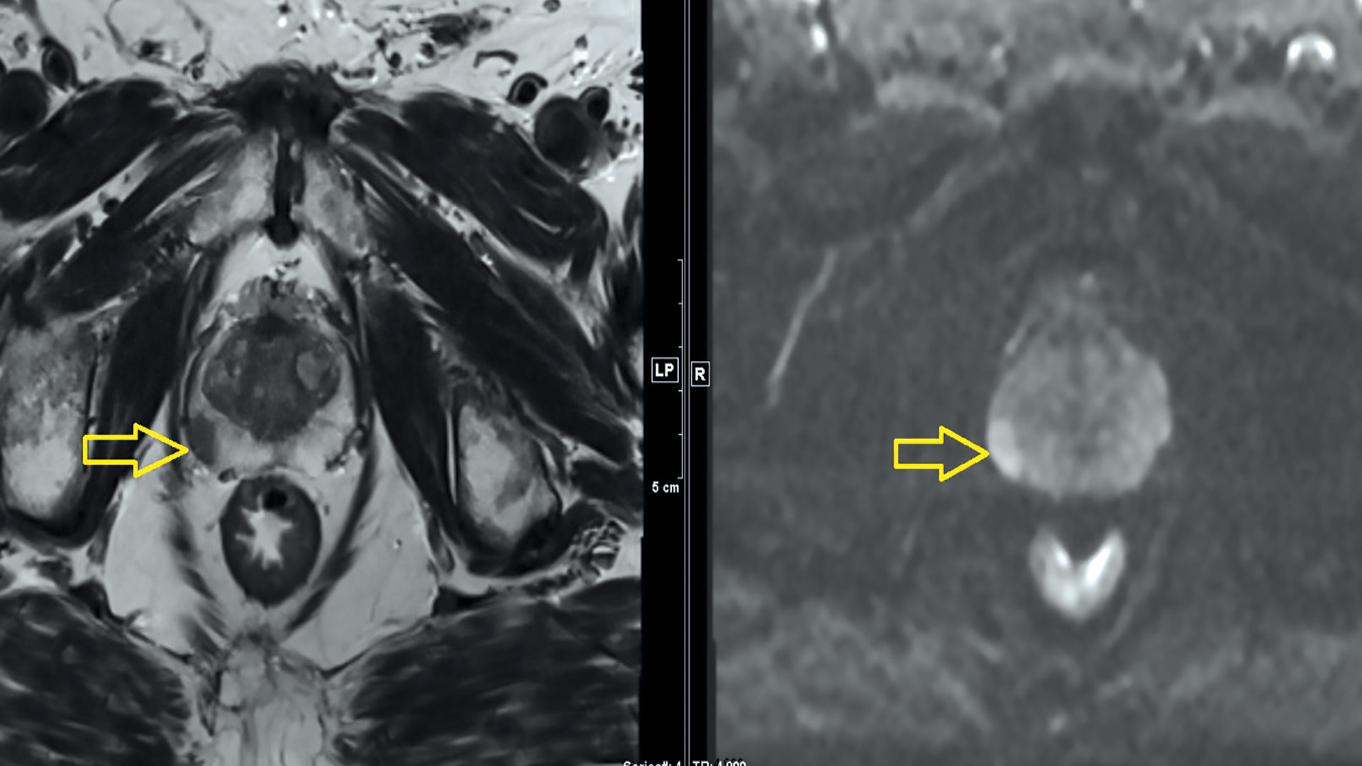 Advanced Imaging, Robotic Surgery Propel Prostate Cancer Management | ACS