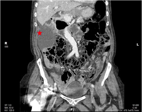 Gallbladder Volvulus: A Rare Entity | ACS