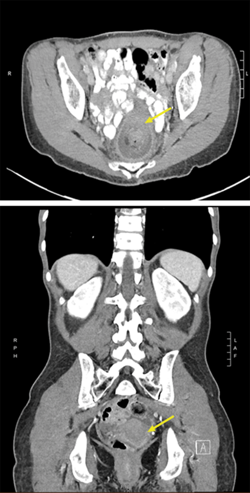 Rectosigmoid Intussusception as a Rare Manifestation of Colorectal ...