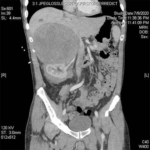 Adrenal Epithelioid Angiosarcoma as a Rare Etiology of Chronic ...