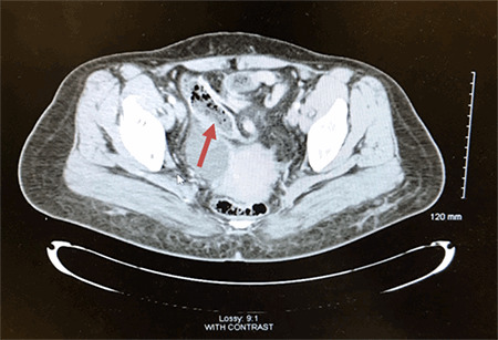 48-Year-Old Female Presents with Intestinal Malrotation and Acute ...