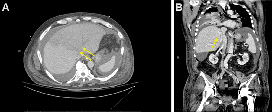 Surgical Management of Unilobar Budd-Chiari Syndrome Following ...