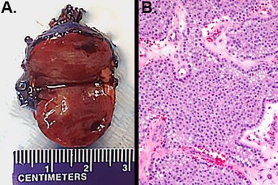 Primary Hyperparathyroidism Presenting as Hypercalcemic Crisis | ACS