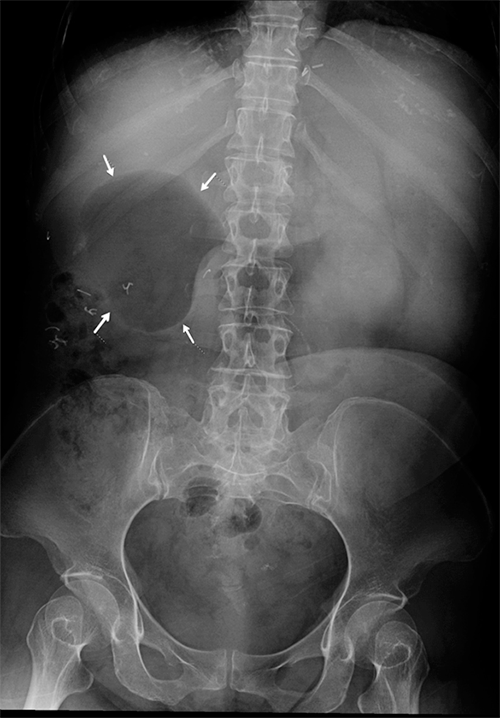 Duodenal Atresia, Intestinal Malrotation, and Gastrojejunal ...