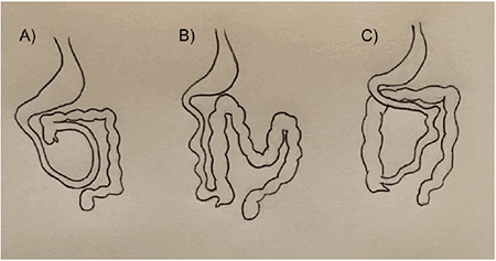 Malrotation Identified during Pancreaticoduodenectomy: A Case Report ...