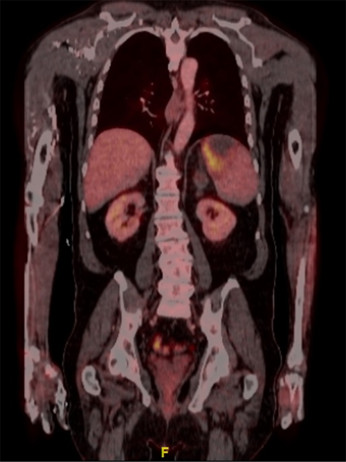 Recurrence of Stage IV Melanoma to the Spleen With Splenomegaly Treated ...