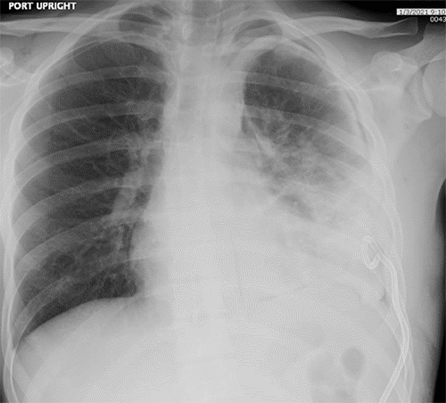 Repeat Thoracic Duct Embolization in Traumatic Thoracic Duct Injury: An ...