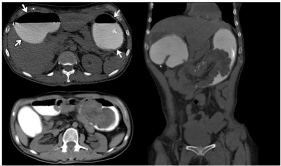 Duodenal Atresia, Intestinal Malrotation, and Gastrojejunal ...