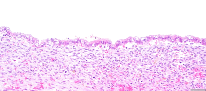A Free Giant Intraabdominal Endometriotic Cyst | ACS