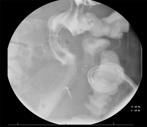 Endoscopic Management of Delayed Duodenojejunal Marginal Ulcer ...