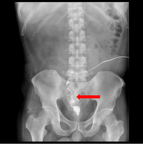 Percutaneous Cyanoacrylate Glue Injection: A Cost-Effective and ...
