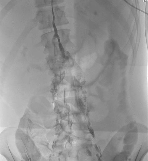 Repeat Thoracic Duct Embolization in Traumatic Thoracic Duct Injury: An ...