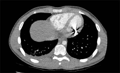 Gunshot Wound to Chest with Embolization of Pellet into the Left ...