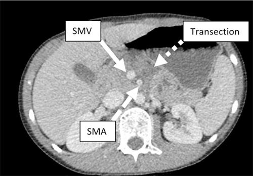 Central Pancreatectomy for a Pediatric Grade 4 Pancreatic Transection | ACS