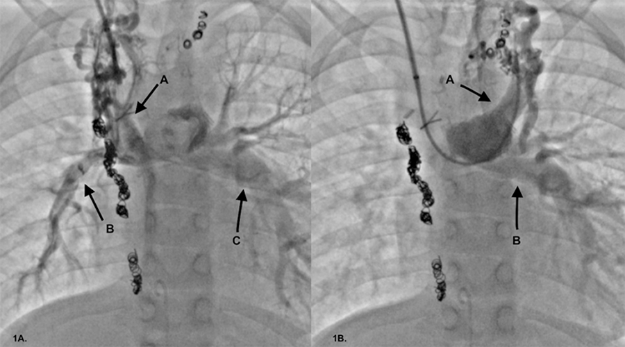 Atrial Appendage Tissue as Autologous Vascular Conduit in Pediatric ...