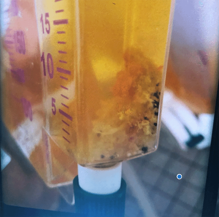 The Poppy Seed Test for Enterovesical Fistula | ACS